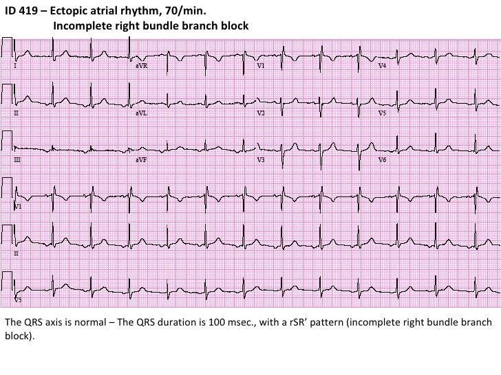 ECG #13 - ID 419 - EAR IRBBB