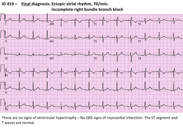 ECG #13 - ID 419 - EAR IRBBB