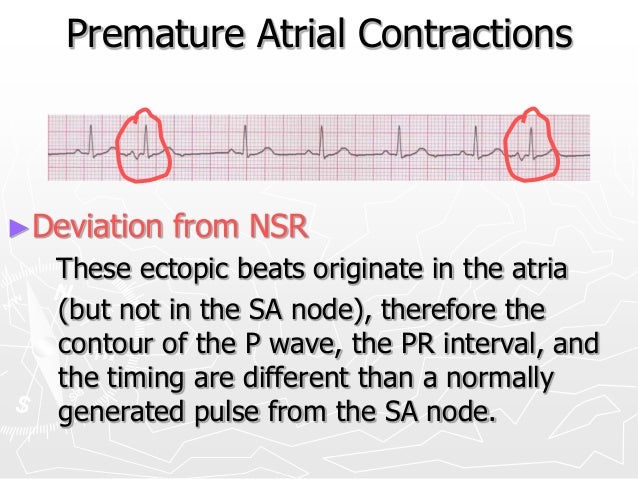 Premature Atrial Contractions Vs Premature Ventricular Contractions