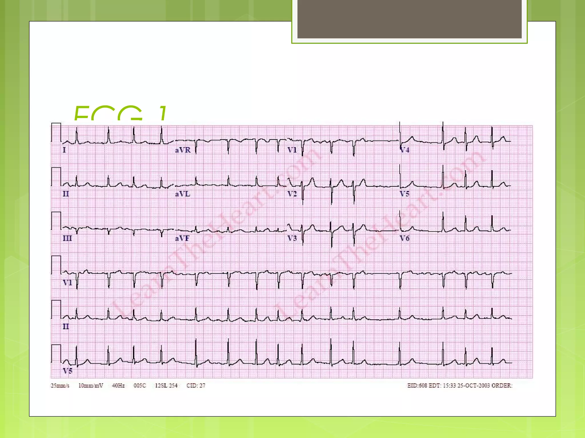 Ecg | PPT