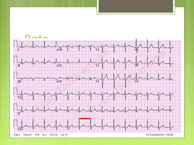 Ecg | PPT