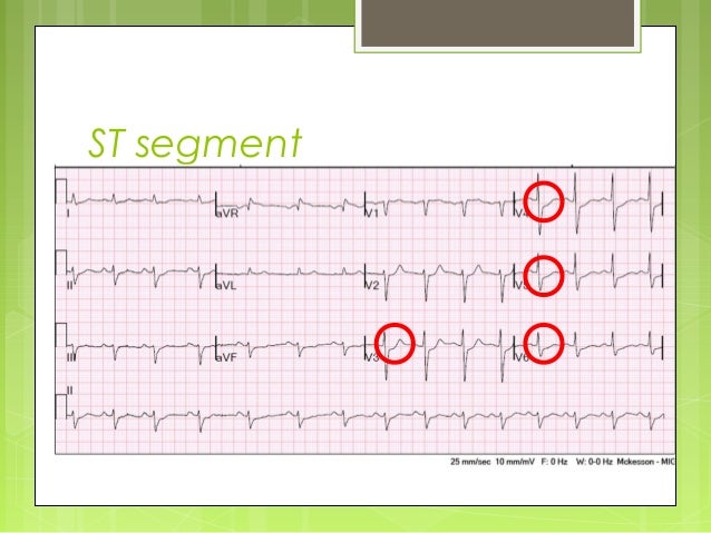 Ecg