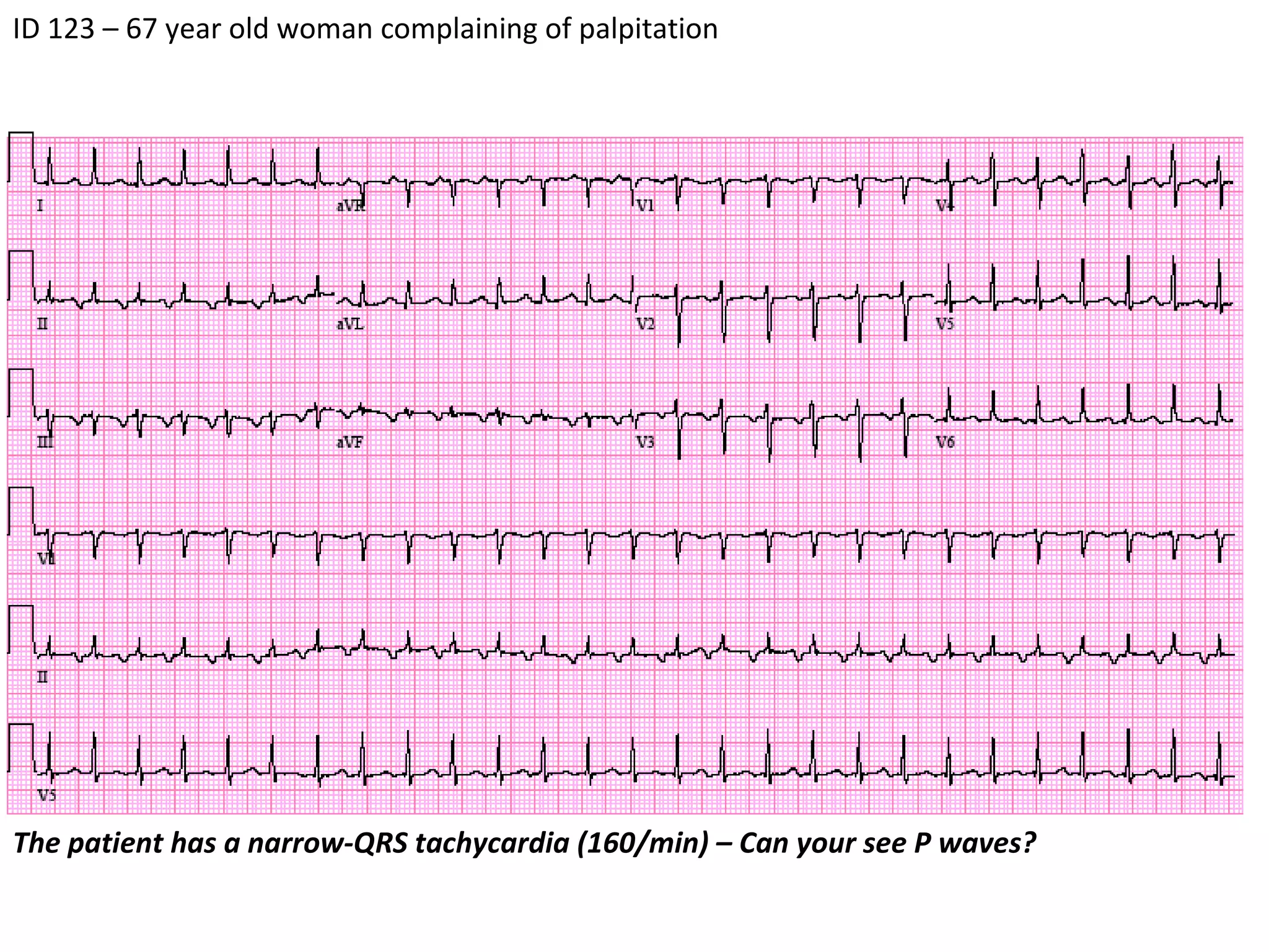 Ecg 14 Id 123 Atrial Tachycardia Ppt
