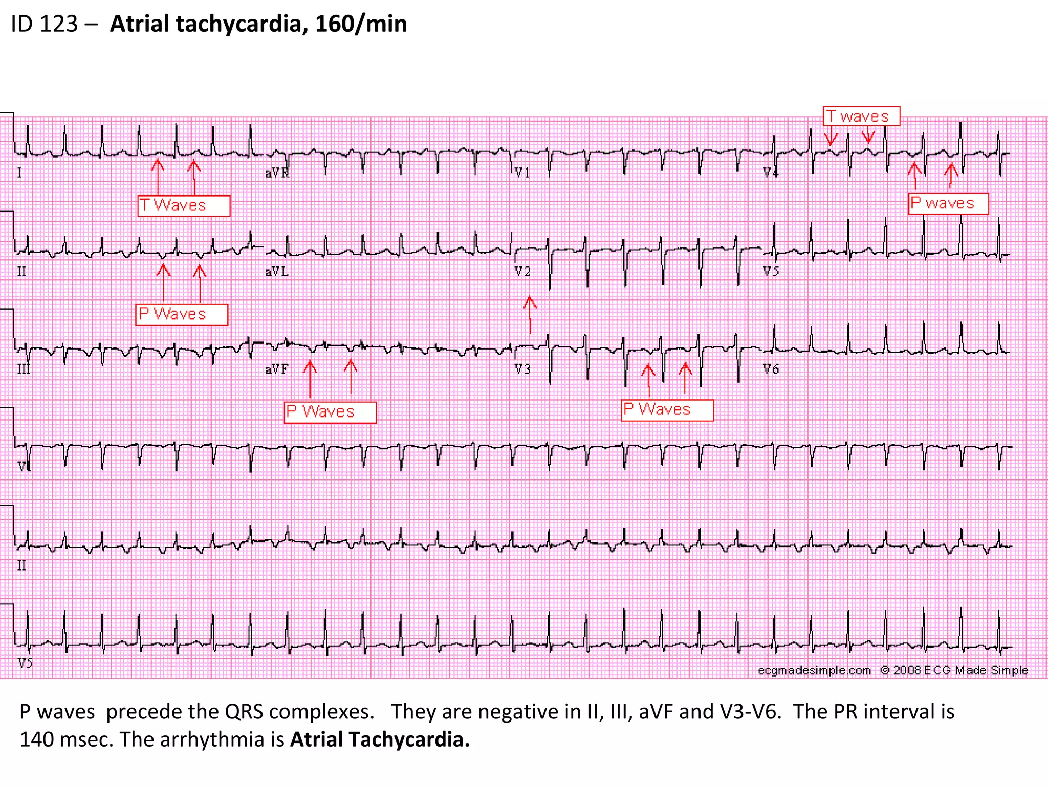 ECG #14 - ID 123 - Atrial Tachycardia | PPT
