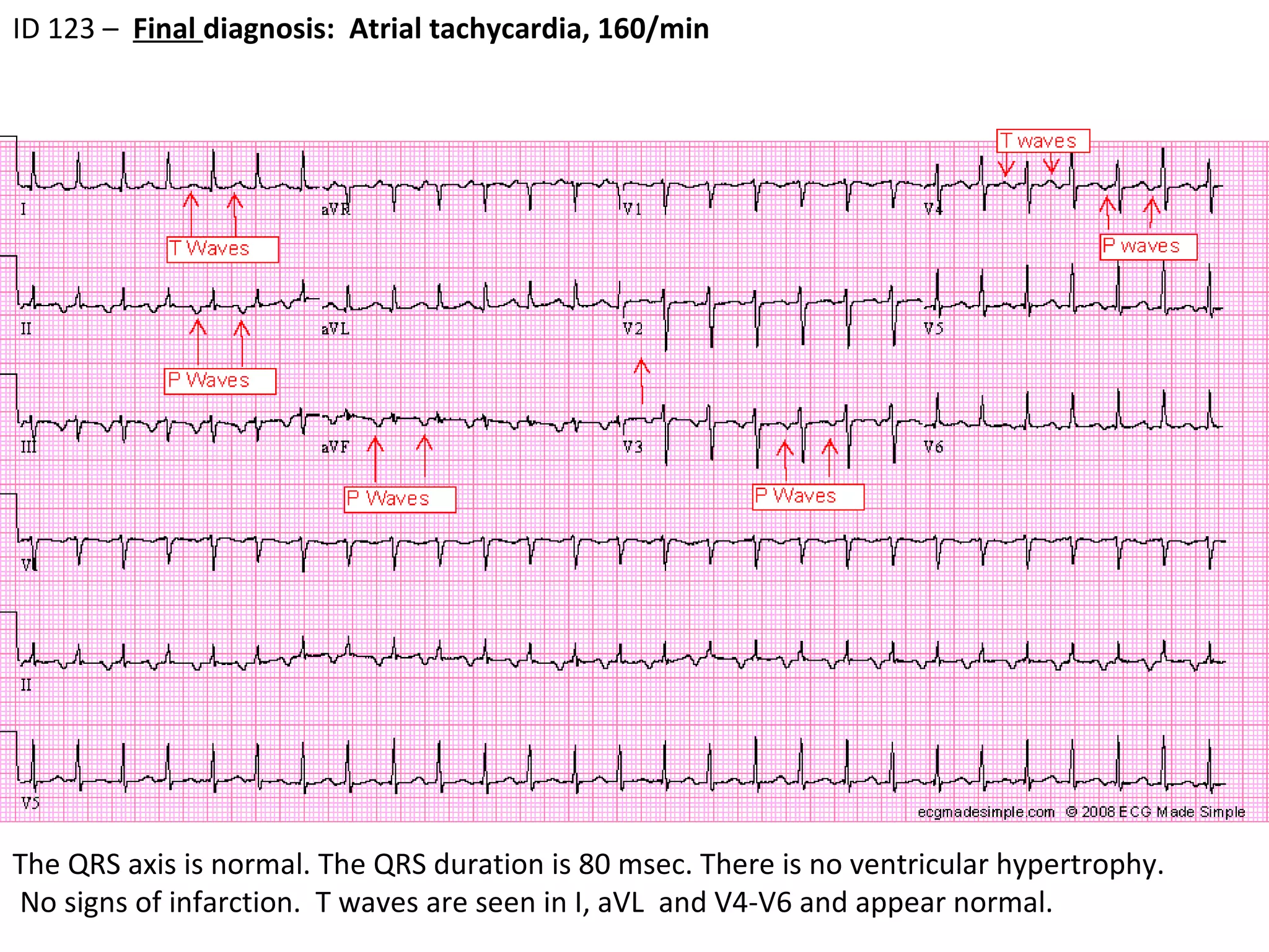ECG #14 - ID 123 - Atrial Tachycardia | PPT