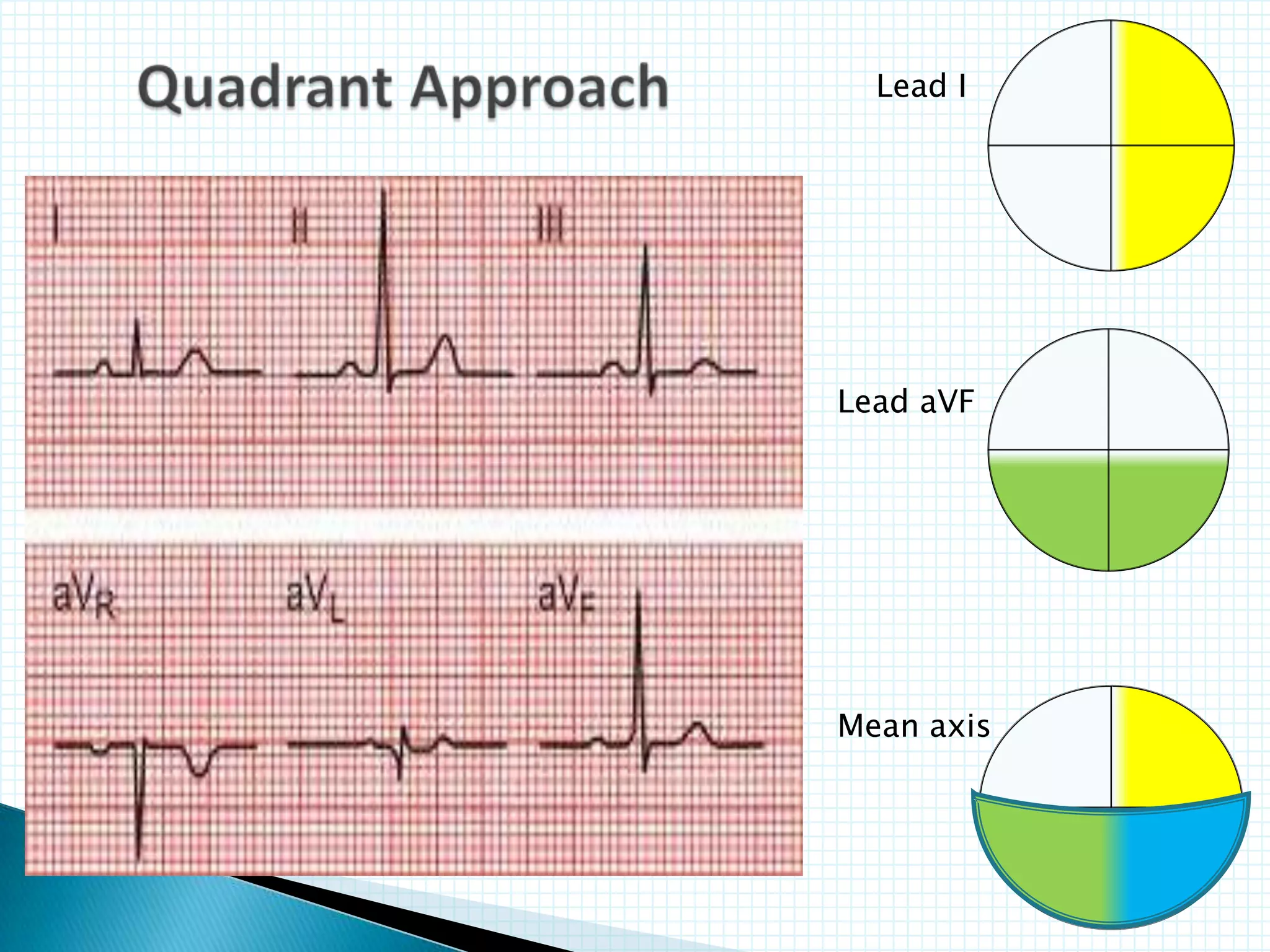 ECG: Indication and Interpretation | PPTX