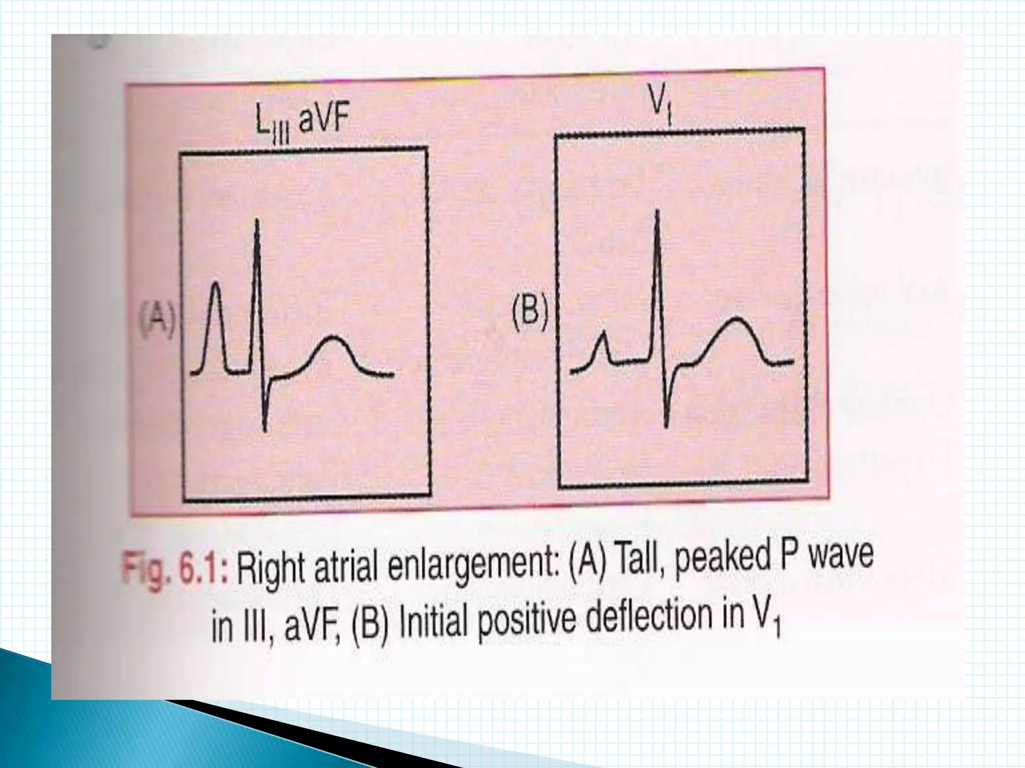ECG: Indication and Interpretation | PPTX