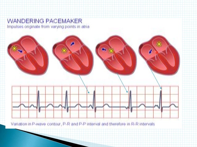 ECG: Indication and Interpretation | PPTX