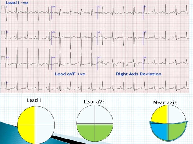 ECG: Indication and Interpretation | PPTX
