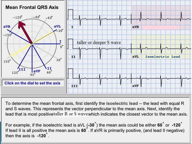 ECG: Indication and Interpretation | PPTX