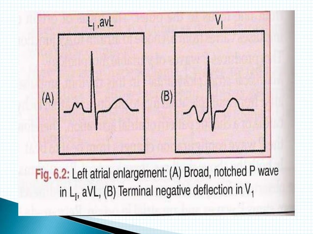 ECG: Indication and Interpretation | PPTX