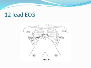 Ecg basics | PPTX