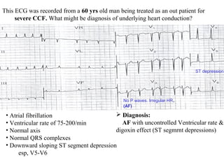 Ecg | PPT