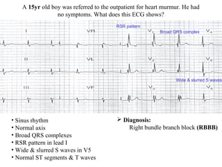 Ecg | PPT