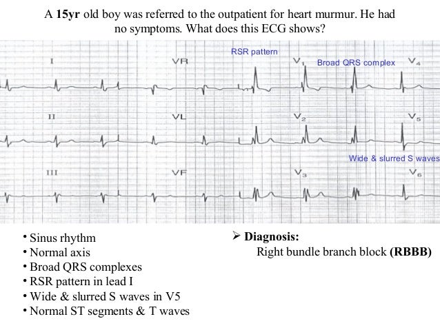 Ecg
