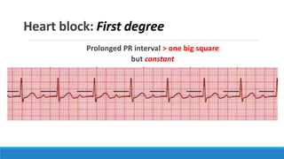 ECG Basics: Video, Anatomy, Definition Function Osmosis, 59% OFF