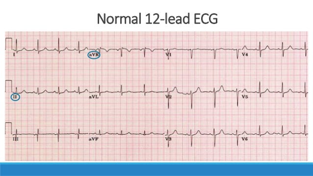 Basic ECG notes