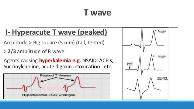 Basic ECG notes