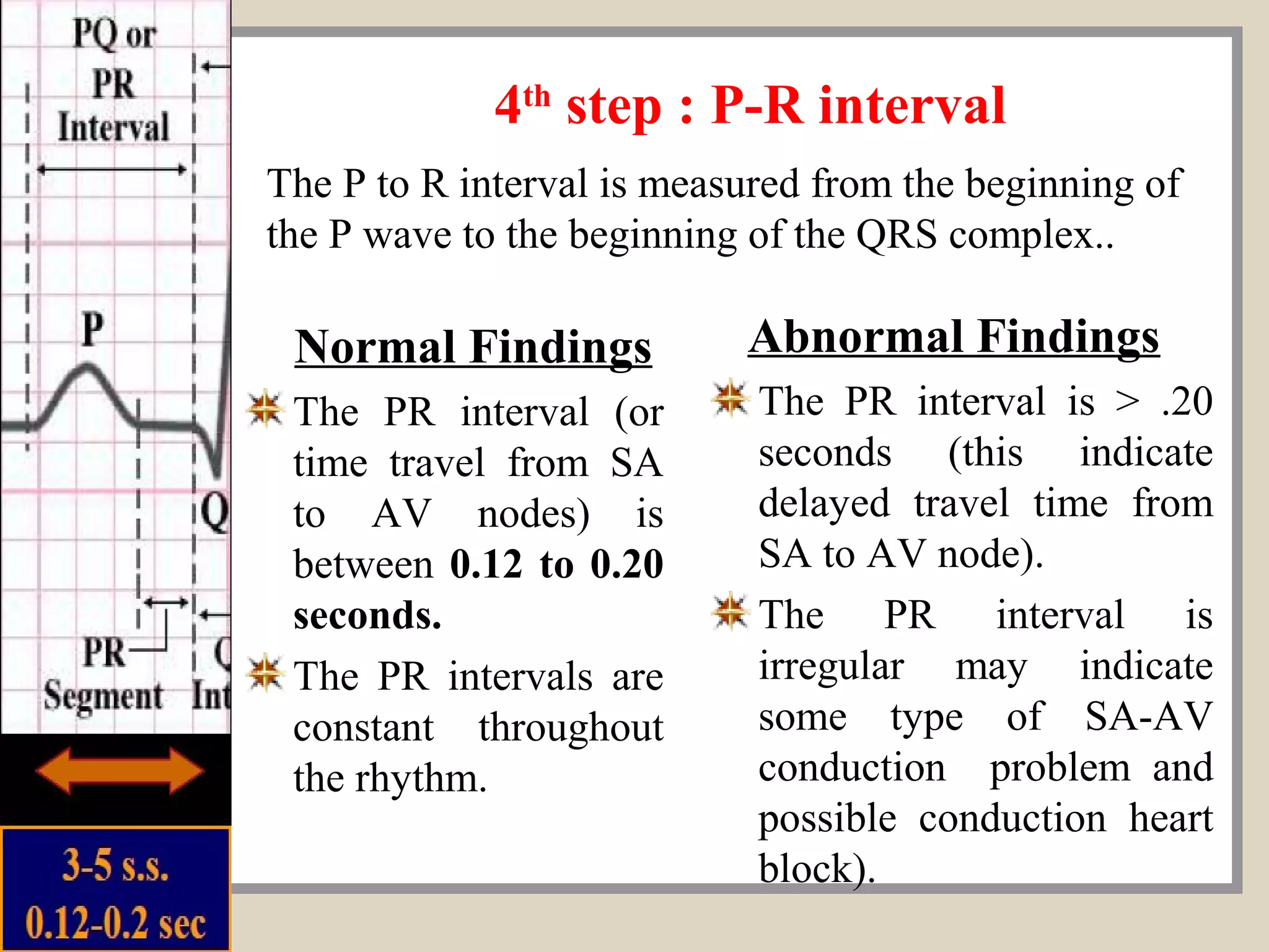 Ecg for Nurses... | PPT