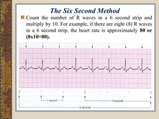 Ecg for Nurses... | PPT