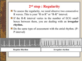 Ecg for Nurses... | PPT