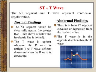 Ecg for Nurses... | PPT