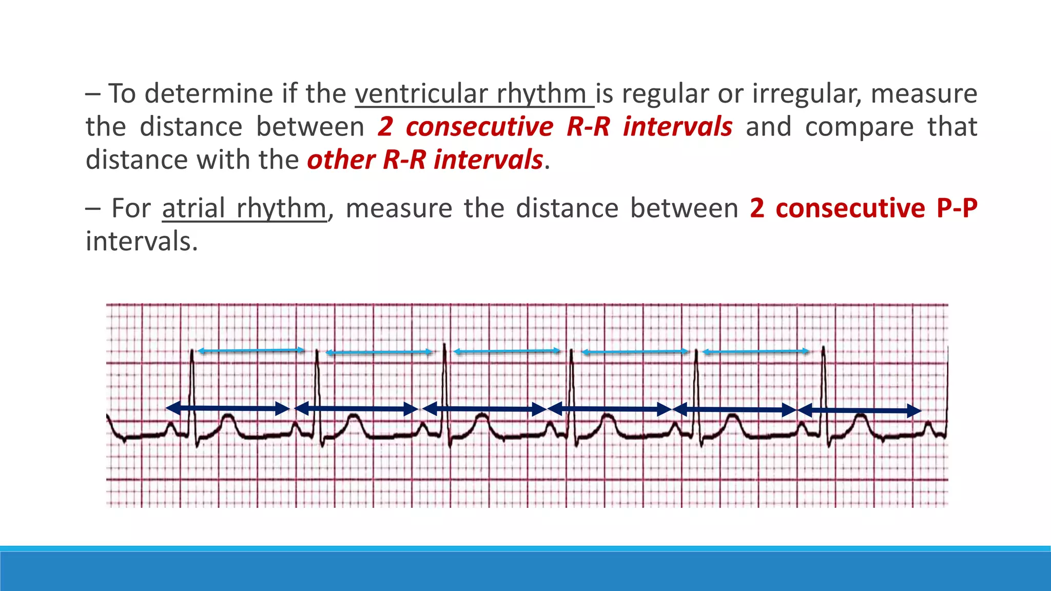 ECG, step by step approach (Updated) | PPTX