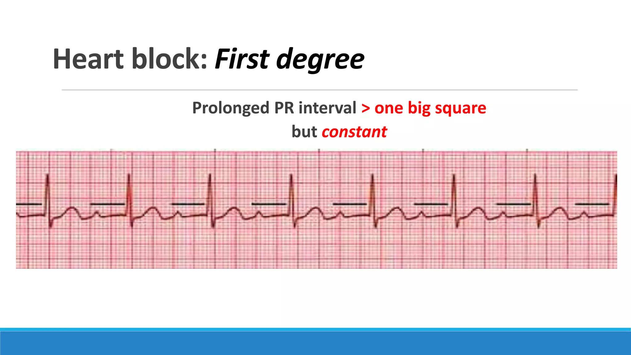 ECG, step by step approach (Updated) | PPTX