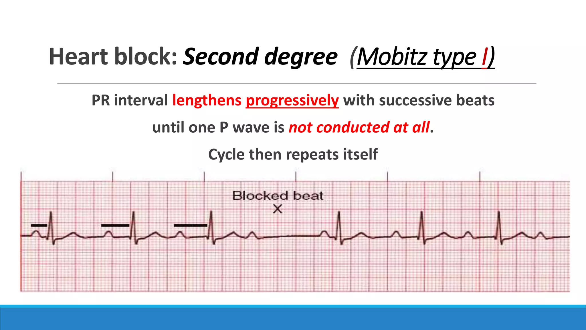 ECG, step by step approach (Updated) | PPTX
