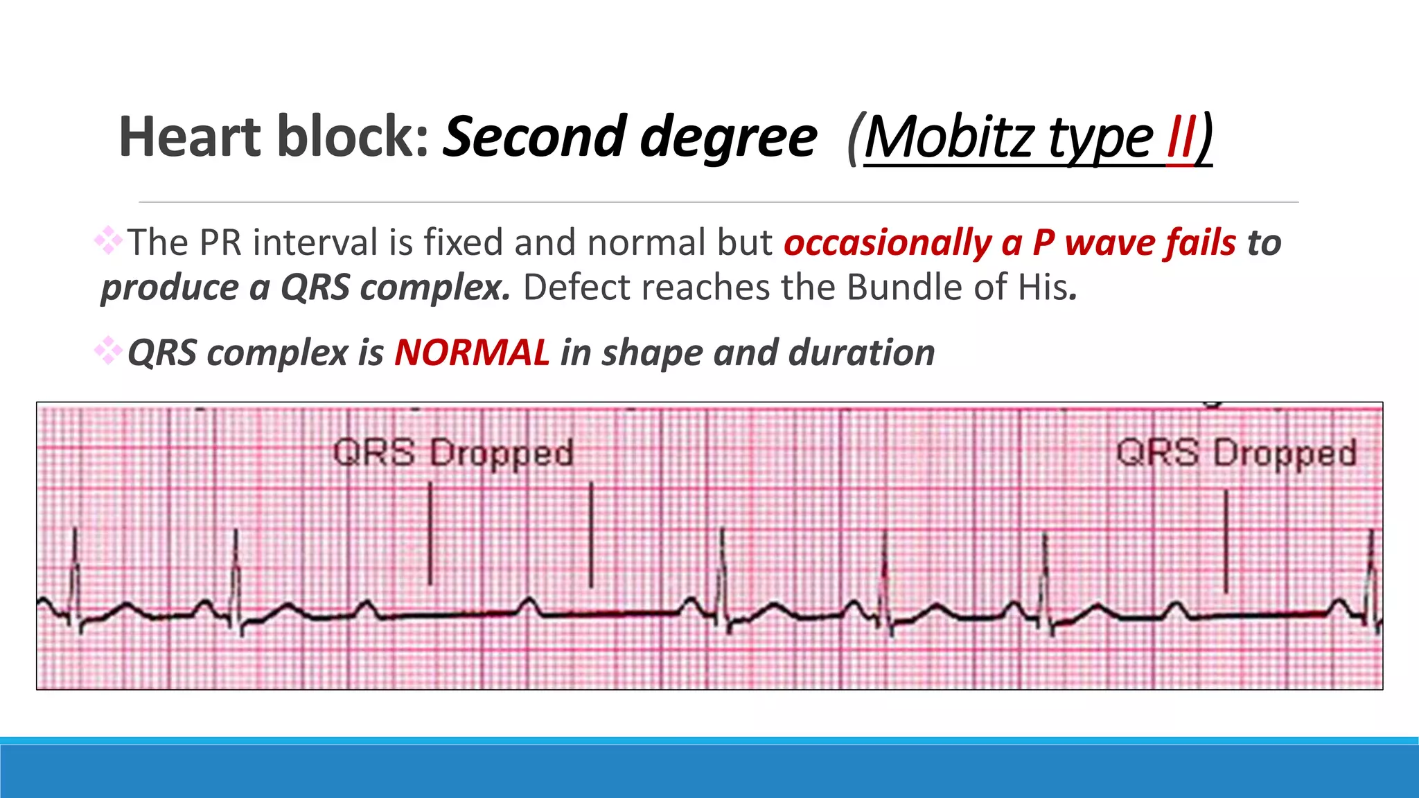 ECG, step by step approach (Updated) | PPTX