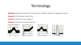 ECG, step by step approach (Updated) | PPTX