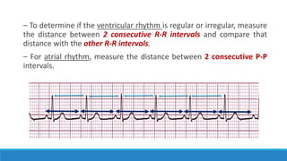 ECG, step by step approach (Updated) | PPTX