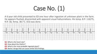 ECG, step by step approach (Updated) | PPTX