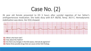 ECG, step by step approach (Updated) | PPTX