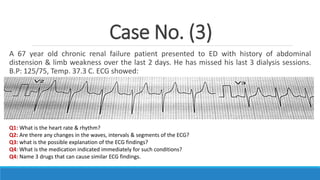 ECG, step by step approach (Updated) | PPTX