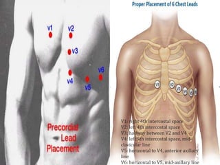topic ECG and heart diseases+treatments | PPTX