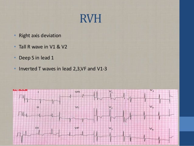ECG
