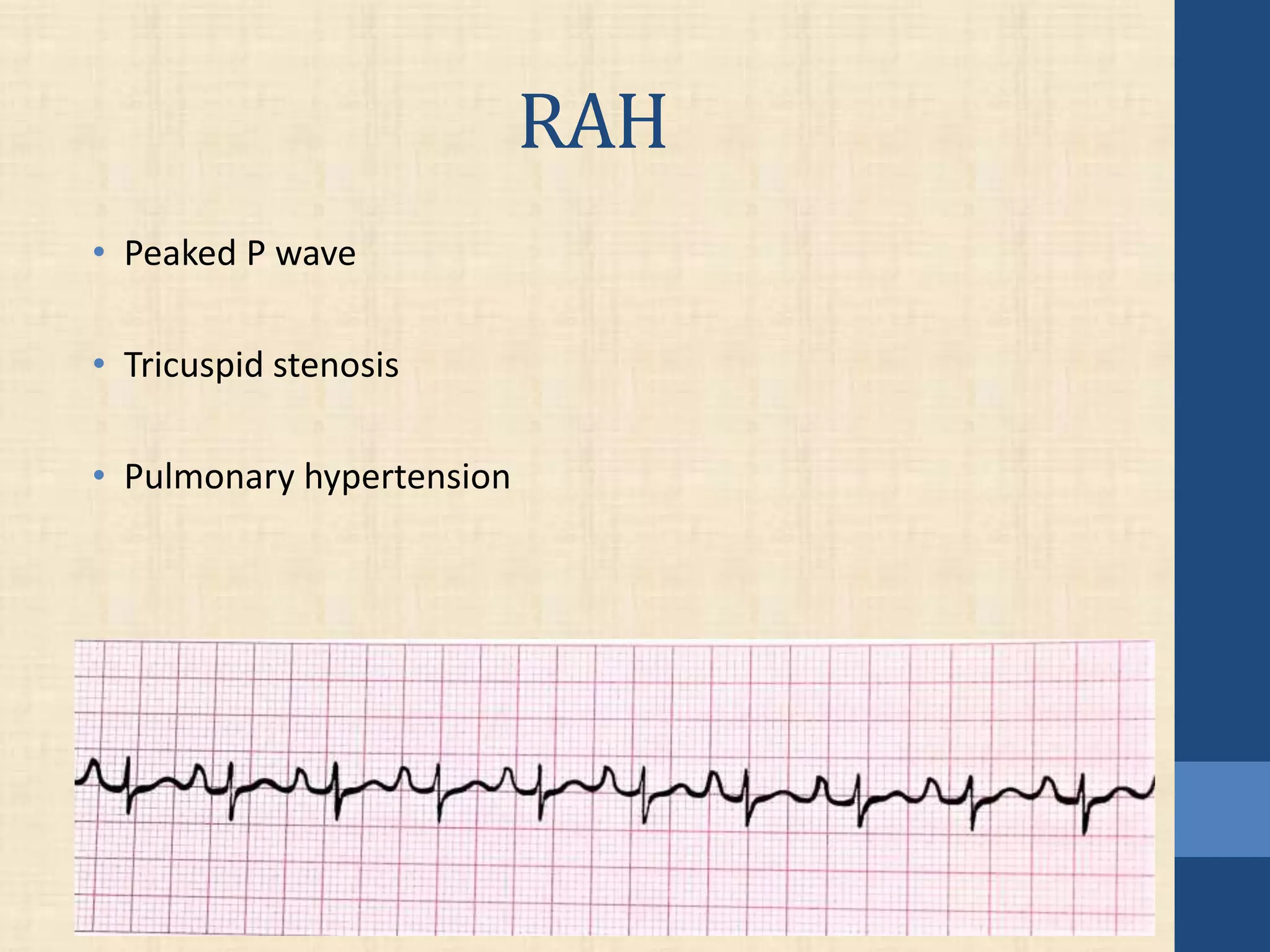 ECG Interpretation | PPTX