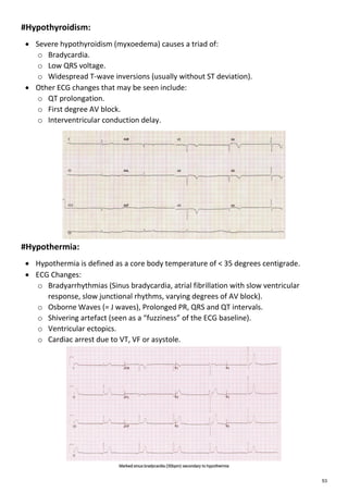 Ecg | PDF