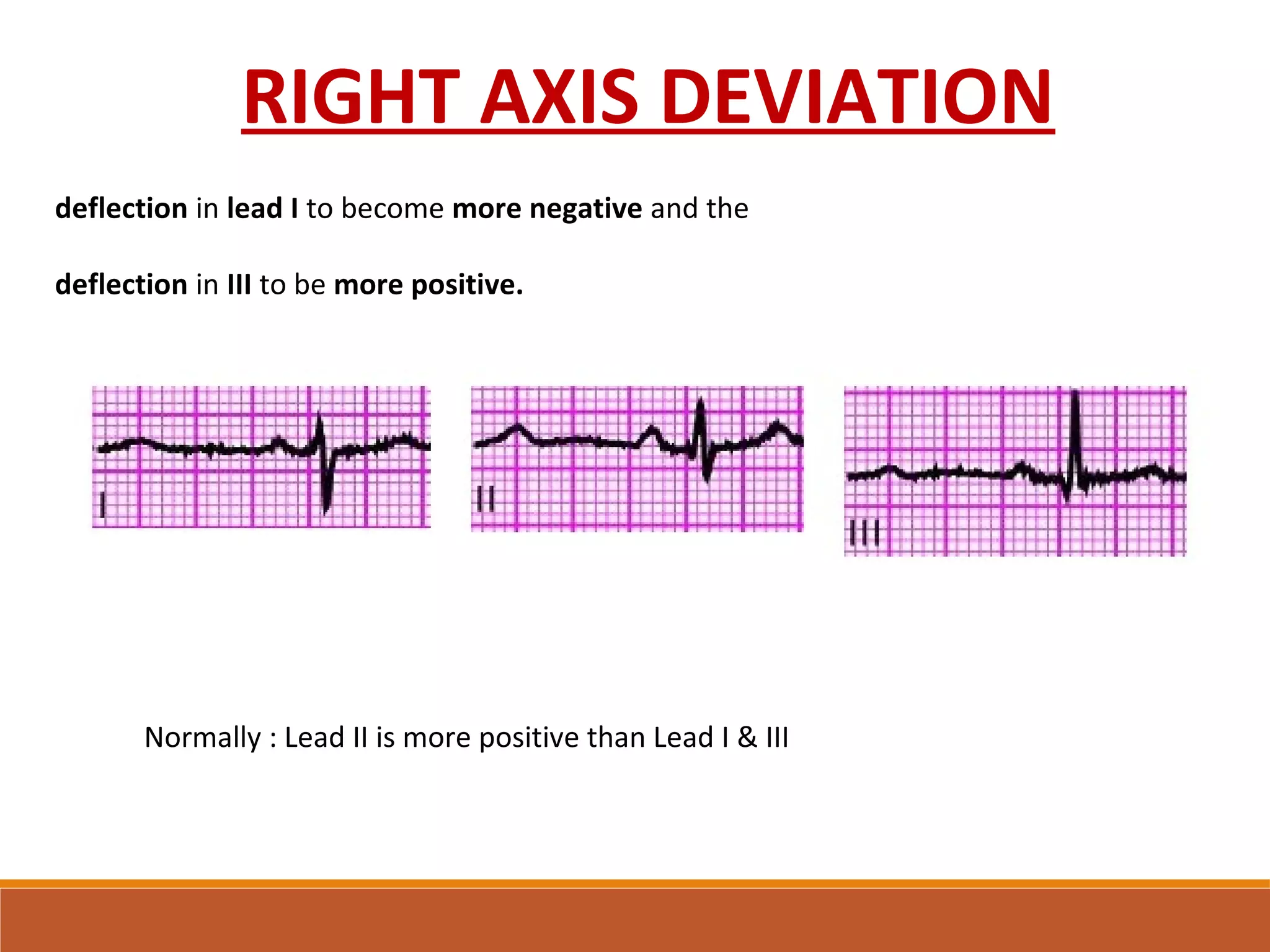Ecg | PPT