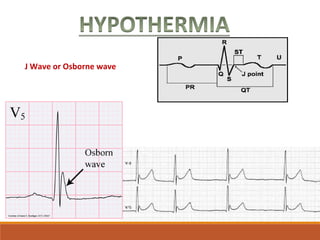 Ecg | PPT