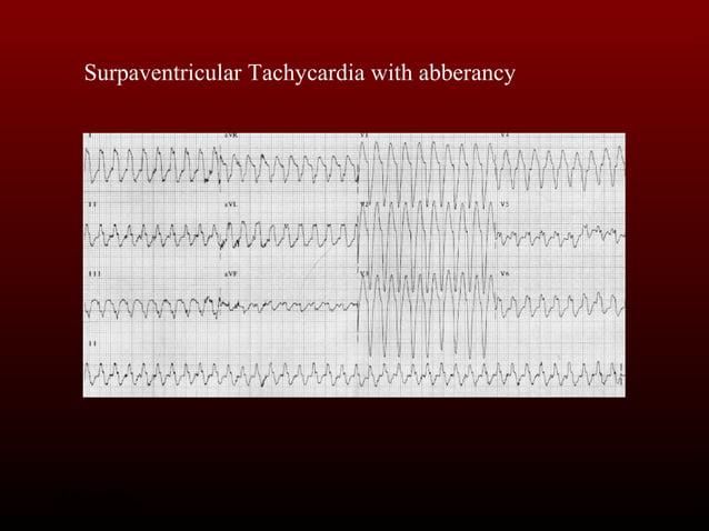 Understanding and Management Of ECG’s | PPT