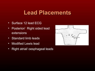 Understanding and Management Of ECG’s | PPT