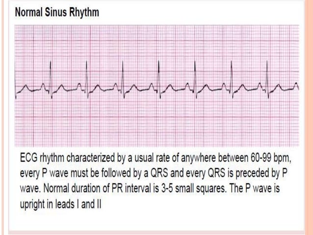 ECG (easy explanation) | PPTX | Heart and Cardiovascular Diseases ...