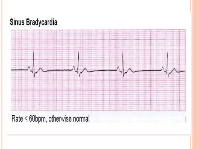ECG (easy explanation) | PPTX | Heart and Cardiovascular Diseases ...