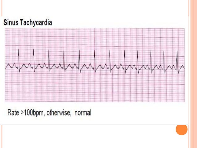 ECG (easy explanation) | PPTX | Heart and Cardiovascular Diseases ...