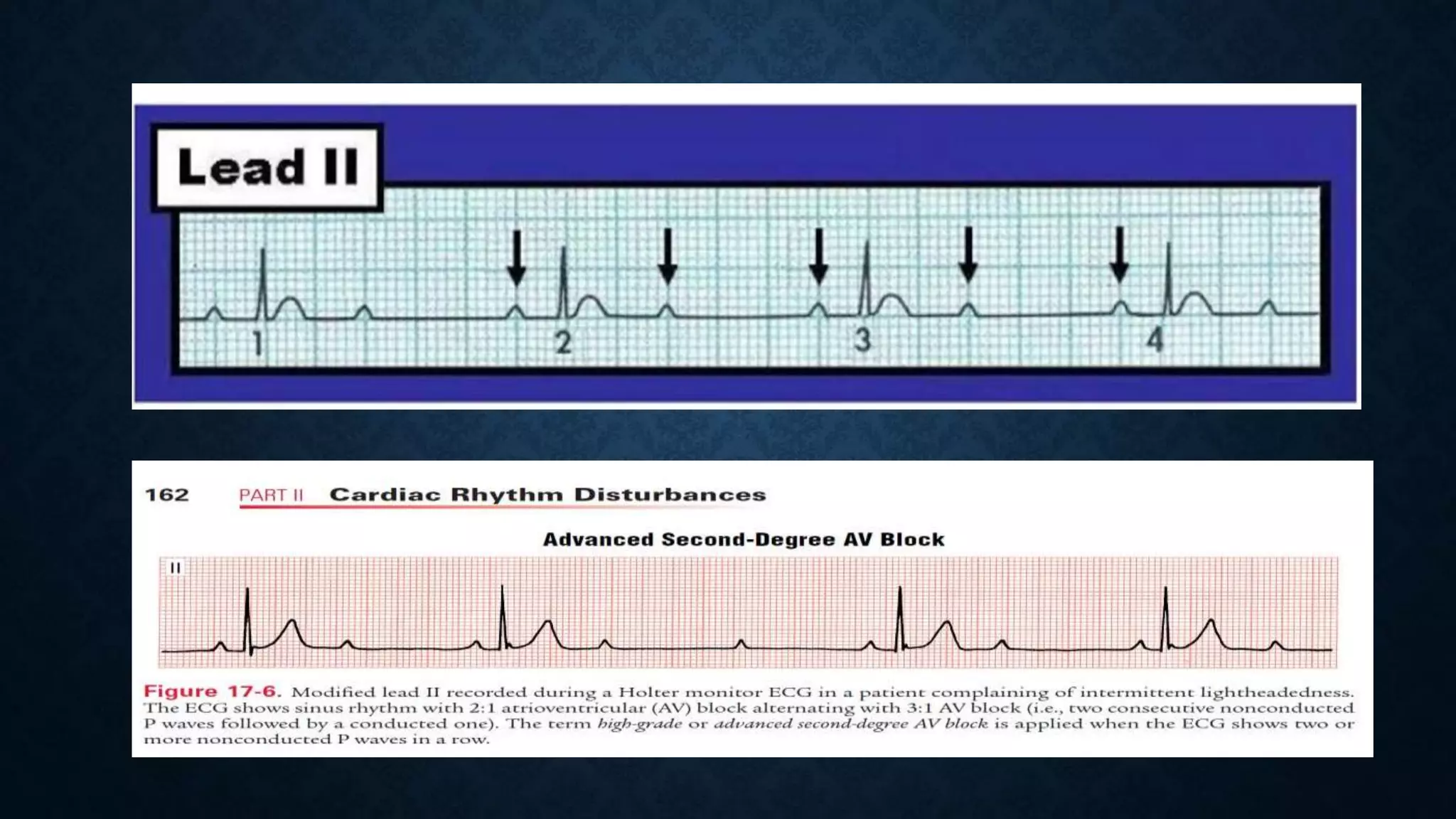 Ecg | PPTX | Heart and Cardiovascular Diseases | Diseases and Conditions