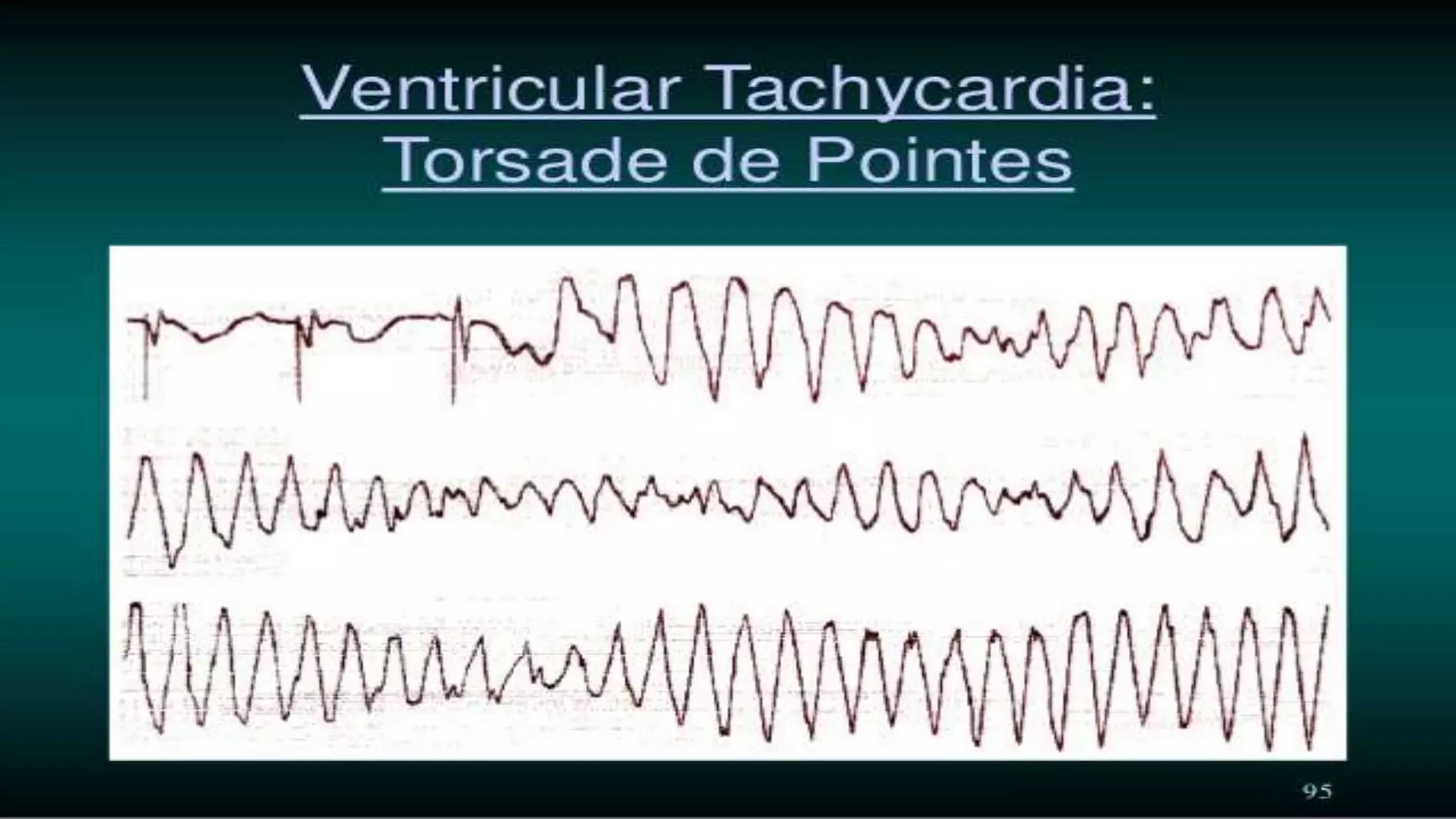 Ecg in children | PPTX