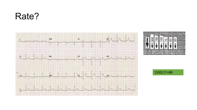 Ecg in children | PPTX | Heart and Cardiovascular Diseases | Diseases ...