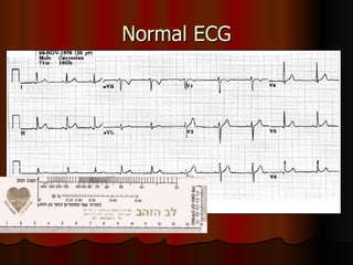 Absolute Refractory Period Ecg